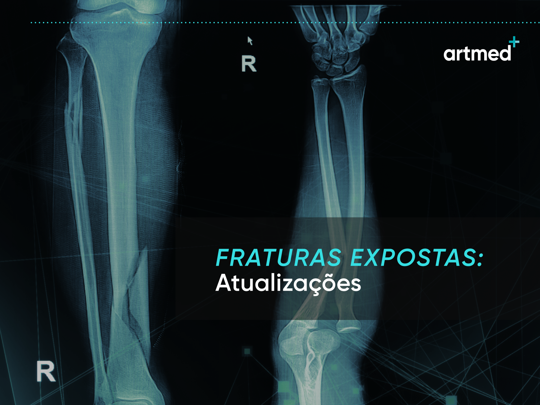 [ARTMED] E-Book | FRATURAS EXPOSTAS